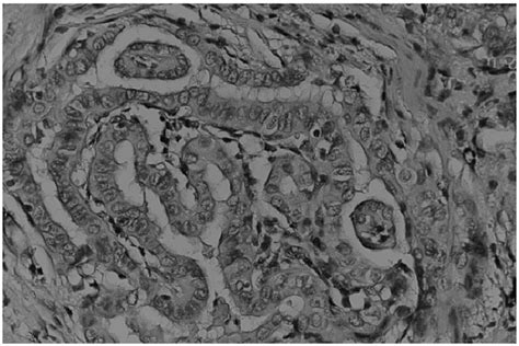 The Photomicrograph Revealing The Histopathology Of Ptc H