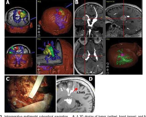 Figure 2 From Multimodal Navigation In The Functional Microsurgical