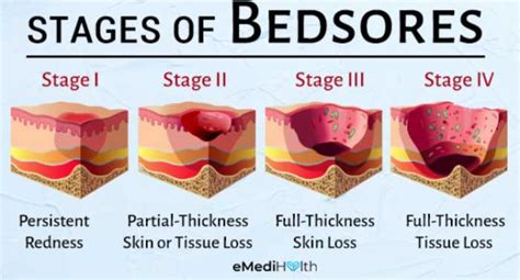 3 Tips To Choosing The Right Ripple Mattress For Bedsores