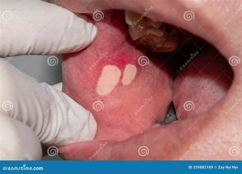 Aphthous Ulcer Or Stress Ulcer In Mouth Of Asian Patient Stock Image Image Of Disease Small