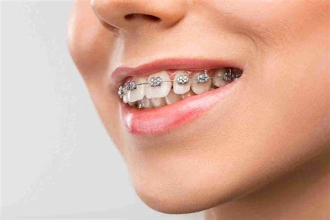 Conventional Braces Benefits Drawbacks Procedure And Aftercare