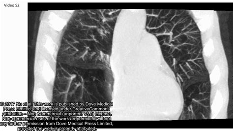 Chest X Ray Hyperinflation Definition At Jill Deleon Blog
