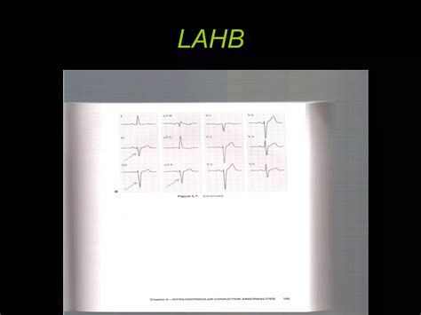 Bundle Branch Blocks PPT