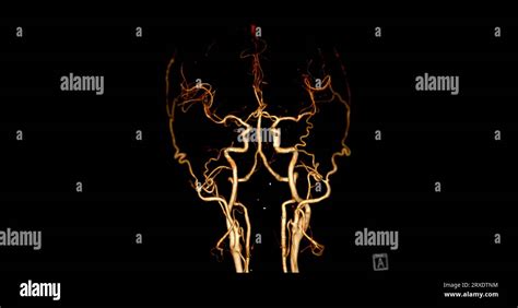 Cta Brain Or Ct Angiography Of The Brain 3d Rendering Image Ap And Lateral View Showing Cerebral