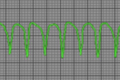 PALS EKG Practice Test Library Learn Master ACLS PALS
