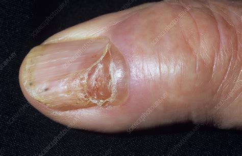 Synovial Cyst Stock Image M1300731 Science Photo Library
