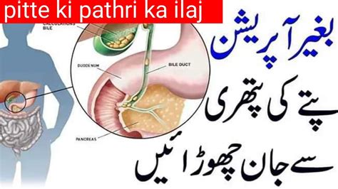 Pittay Ki Pathri Ka Ilaj In Urdu I Pittay Ki Pathri Ka Ilaj I Pitay Ki
