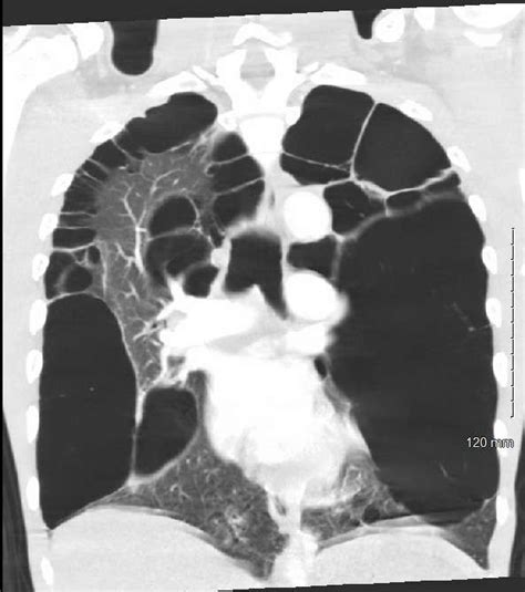 Emphysema Meded Cases