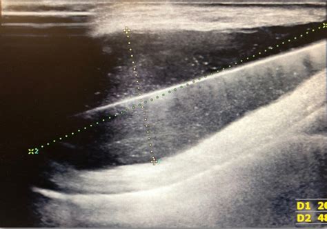 A Superficial Ultrasound Of The Tissues Of The Left Subclavian Region