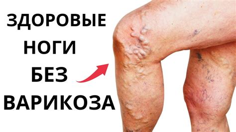 ЕСТЬ ВАРИКОЗ ДЕЛАЙТЕ ЭТО Варикозное расширение вен боли в ногах ревматизм артрит боль в