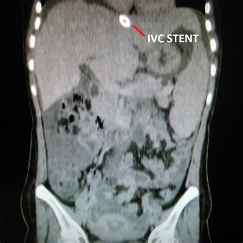 Ct Abdomen Showing Intra Abdominal Inferior Vena Cava Thrombosis
