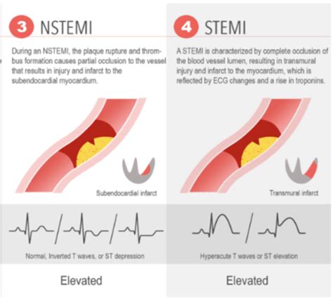 Coronary Artery Disease Flashcards Quizlet