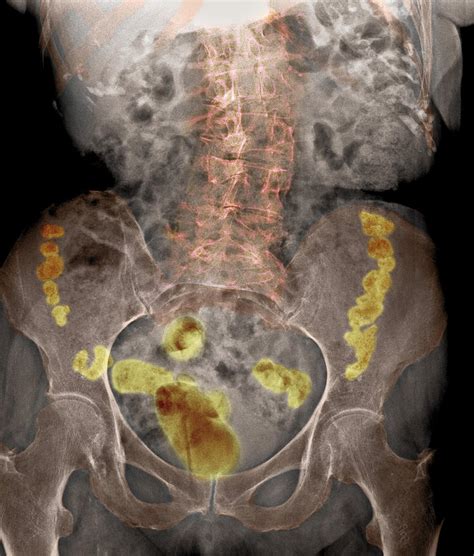 Spinal Osteoporosis X Ray Photograph By Du Cane Medical Imaging Ltd