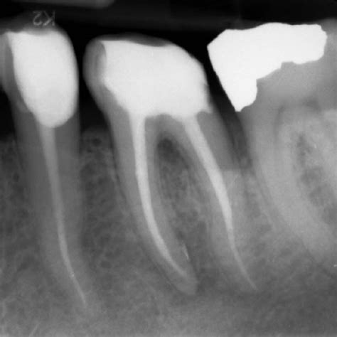 Kreena Patel On Linkedin Endodontics Endo Saveteeth Endodontia