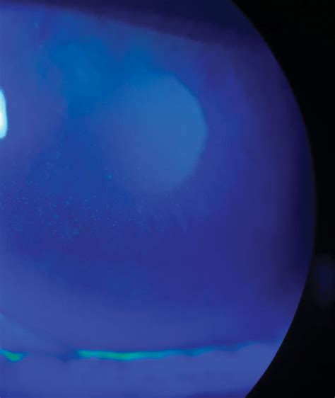 At The Intersection Of Sex And Dry Eye