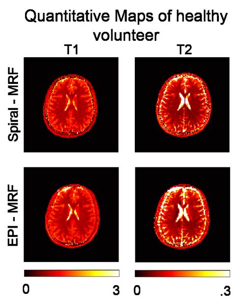 Figure Showing The T And T Maps In Seconds Of The Healthy Volunteer