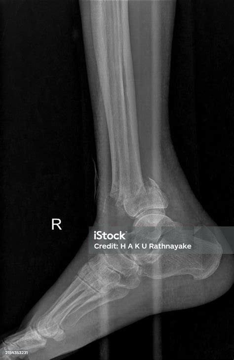 遠位脛骨腓骨骨折を伴う右足首の外側x線写真 脛骨のストックフォトや画像を多数ご用意 脛骨 スリランカ データ Istock