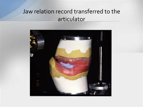 Methods Of Recording Centric Jaw Relation Ppt At Neal Marquez Blog