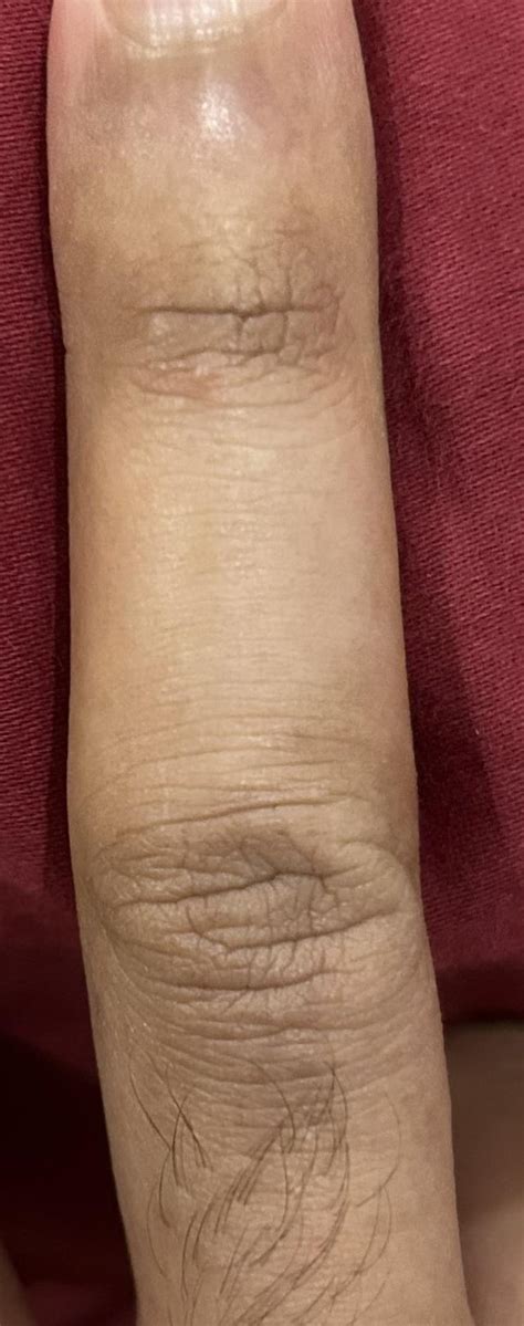 Please Help Me New Spots Post Scabies Rscabies