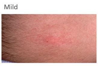Subcutaneous Immunoglobulin SCIg Therapy General Information