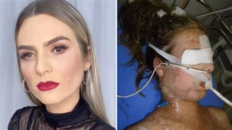 Woman Left In 17 Day Coma ‘burning From The Inside Out After Taking