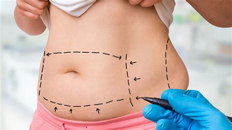 Woman Left Feeling Like Frankenstein After Plastic Surgeon Allegedly
