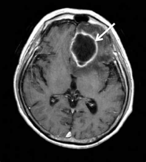 Citrobacter Koseri é Grave Retoedu