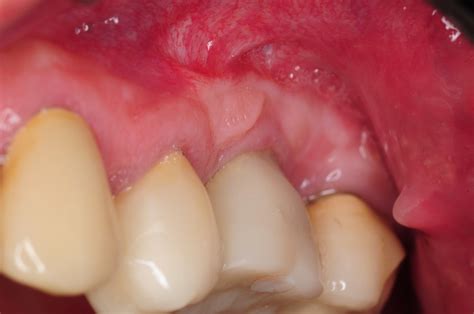 Gingival Graft For Augmenting Attached Keratinized Gingiva Gingival