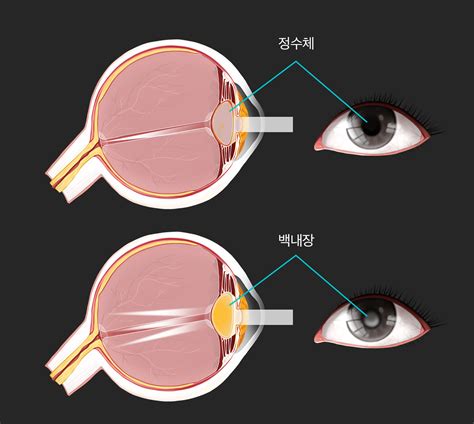 갑자기 시야가 뿌옇게 백내장 증상 백내장 증상 수술 원인 예방법 알아보기 닥터나우