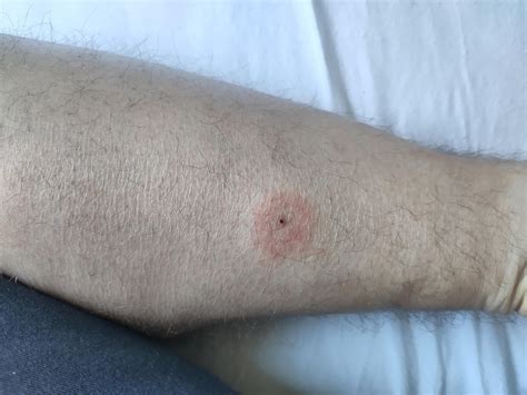 Bug Bite Itchy Rash After 2 Weeks Uk R Medical