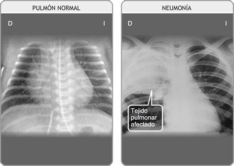 Effects Emphysema Emphysema Symptoms And Causes