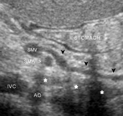 Inferior Mesenteric Artery Ultrasound