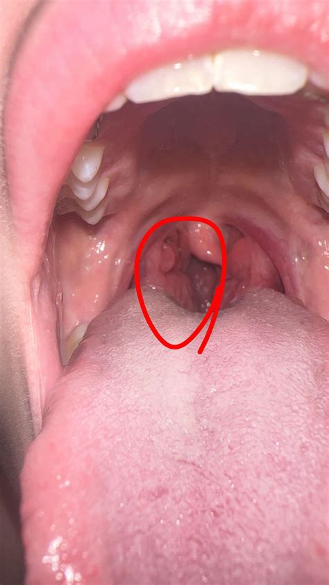 Tonsil Bump Rmedicaladvice
