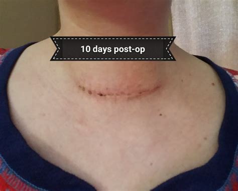 Life After Thyroidectomy Parathyroidectomy Photos Artofit