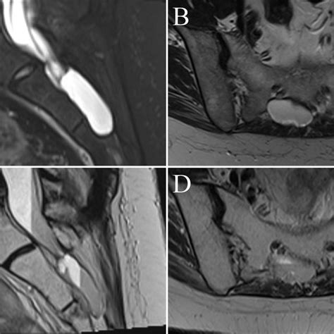 Sagittal A And Axial B Mri Scans From 1 Year Before Presentation
