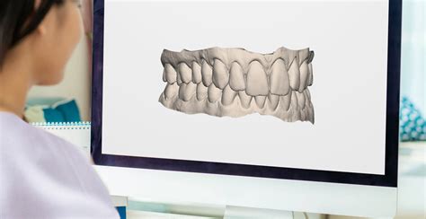Invisible Braces From Newsmile™ Straighten Teeth At Home