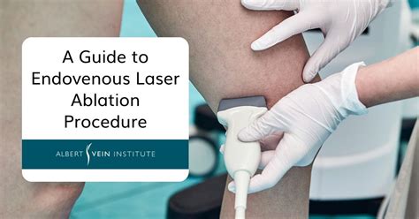 A Guide To Endovenous Laser Ablation Procedure Albert Vein Institute