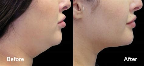 Coolsculpting For Double Chin Aesthetica Medical Spa