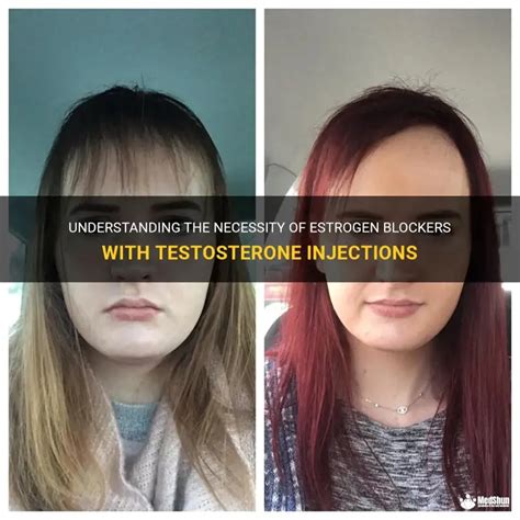 Understanding The Necessity Of Estrogen Blockers With Testosterone