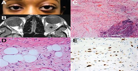 Atypical Lipomatous Tumorwell Differentiated Liposarcoma Of