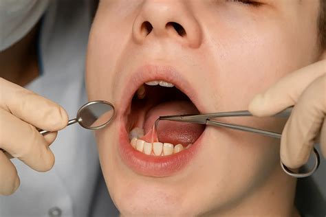 Comprehensive Guide To Frenectomy Procedure Types Cost And Faqs İstanbul Mosdent Dental