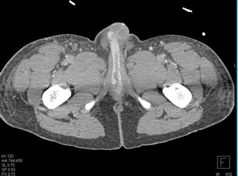 Pseudoaneurysm Near Urethra Vascular Case Studies Ctisus Ct Scanning