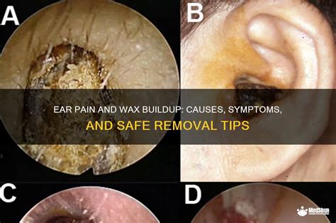 Ear Pain And Wax Buildup Causes Symptoms And Safe Removal Tips Medshun