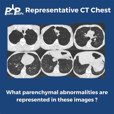 Hyperinflation Pulmpeeps