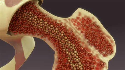 Bone Marrow Cancer Types And Treatment Oncoplus Hospital