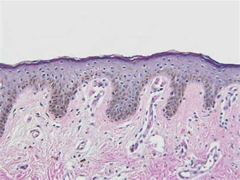 Pathology Outlines Nevi General