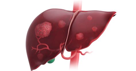 Incidence Of Liver And Non Liver Cancers After Hepatitis C Virus