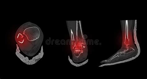 ct scan ankle and foot or computed tomography of ankle joint and foot