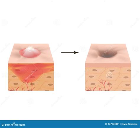 Inflamed Acne On The Skin Inflamed Pimple The Structure Of The Skin