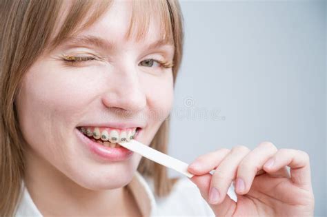 Young Woman With Metal Braces On Her Teeth Is Chewing Gum The Girl Is